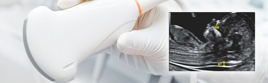 Enhanced First Trimester screening or NT scan – Apollo Centre for Fetal ...
